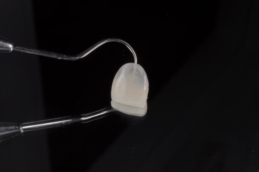 Remake of Fractured PFZ Crown with Full Feldspathic Crown | Dental Case ...